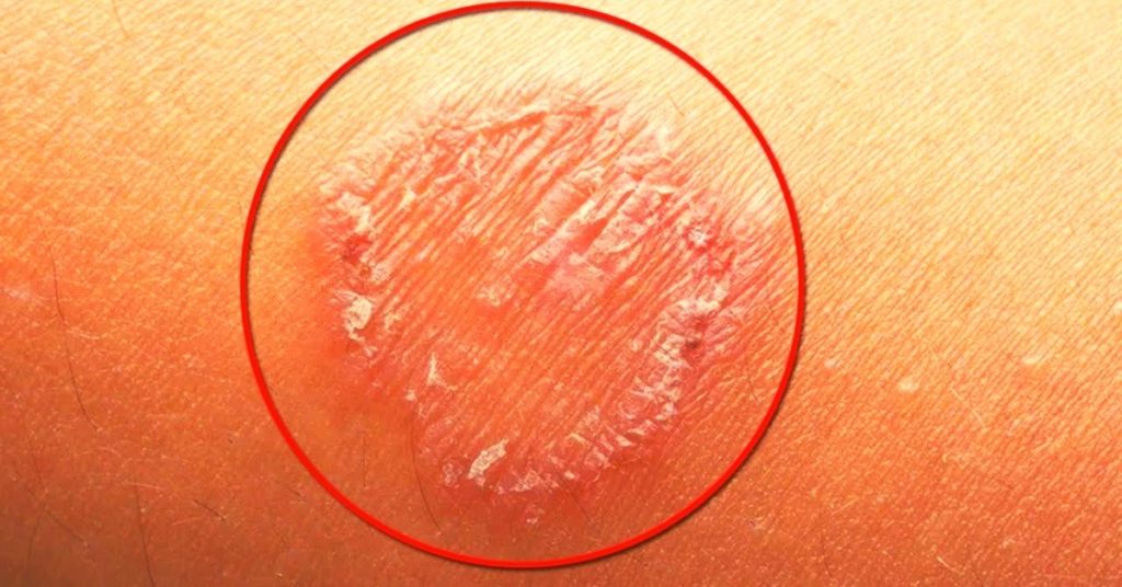 Best Essential Oils And Recipes For Ringworm To Use Effectively